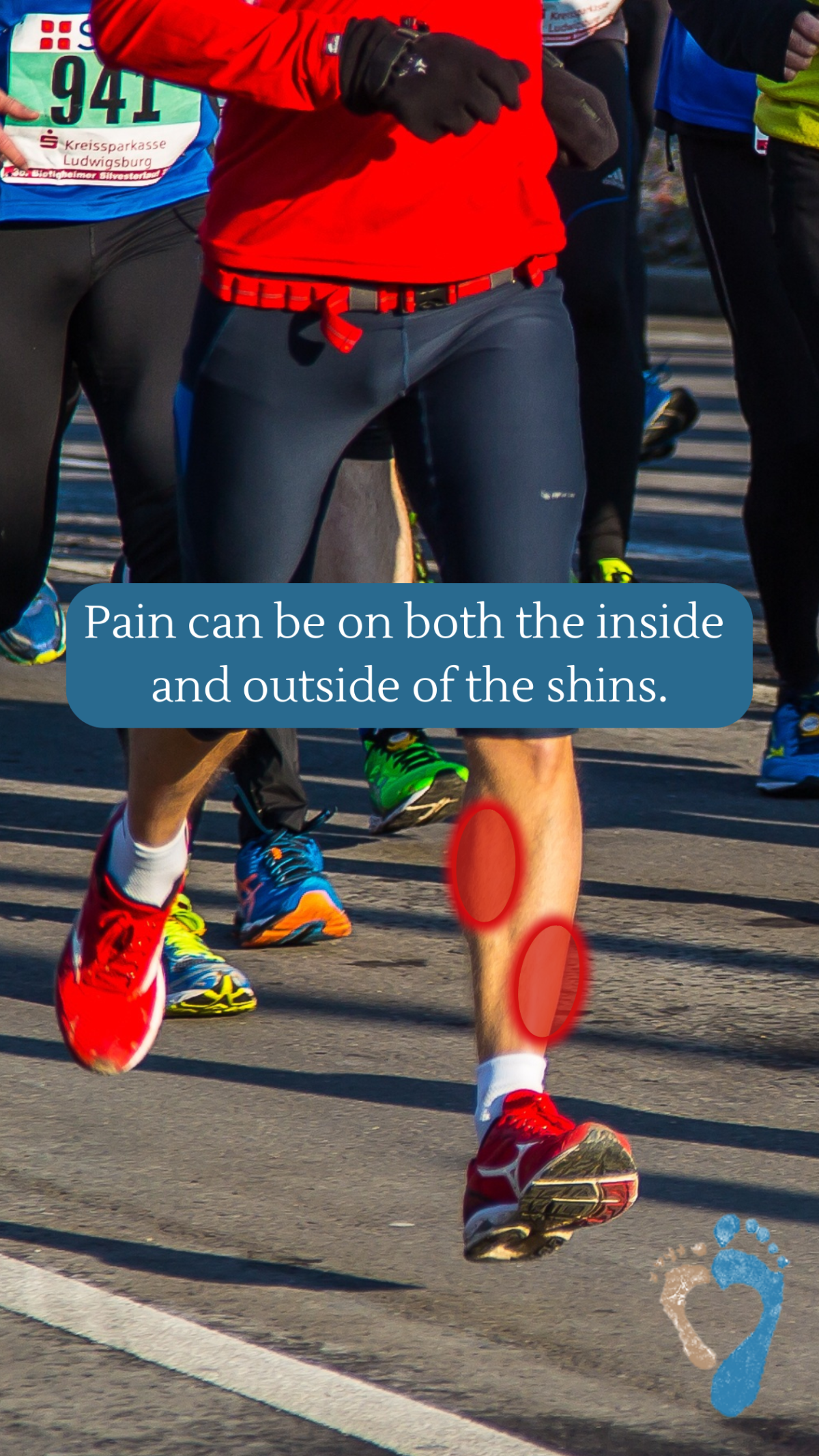 Treating Shin Splints: Effective Chiropody Solutions - Werkman, Boven ...